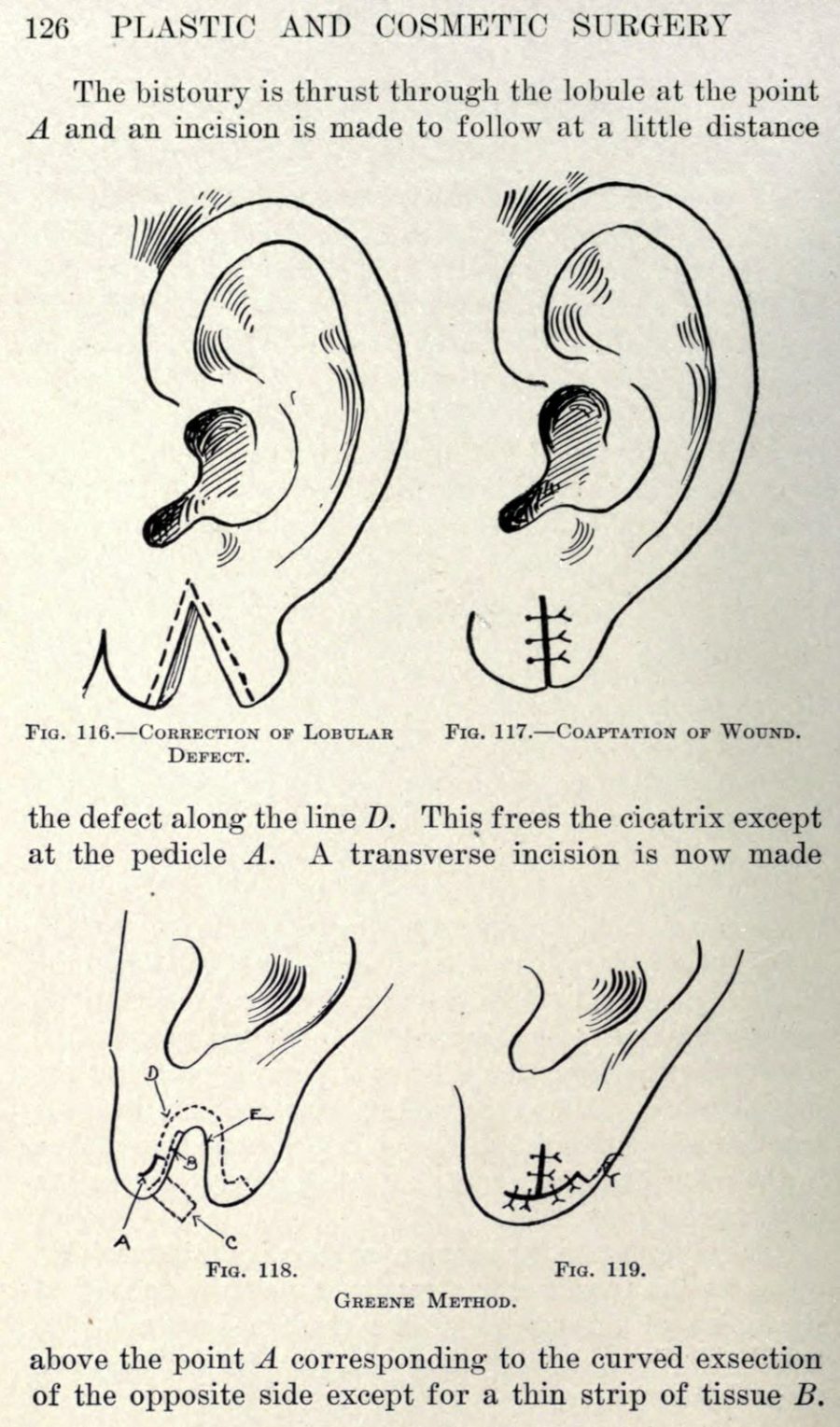 Plastic surgery in the 1920s: How WWI and Hollywood fueled the frenzy ...