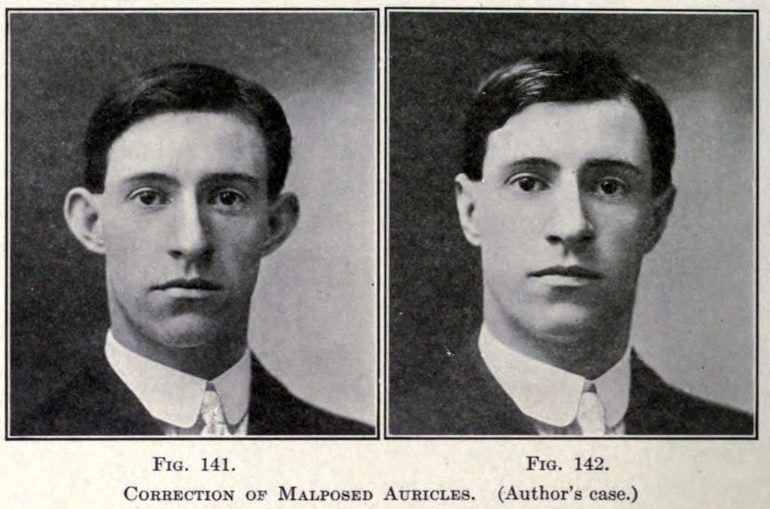 Plastic surgery in the 1920s: How WWI and Hollywood fueled the frenzy ...