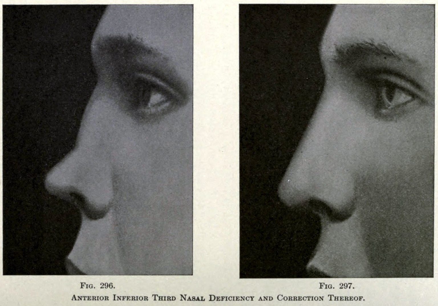 Plastic surgery in the 1920s: How WWI and Hollywood fueled the frenzy ...