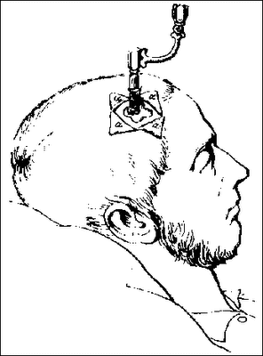 Modern brain surgery, 1890s-style (1893) - Click Americana